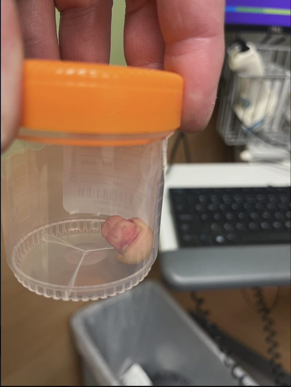 DHS Posts Gross Picture of Agent's Bloody Finger Bit Off